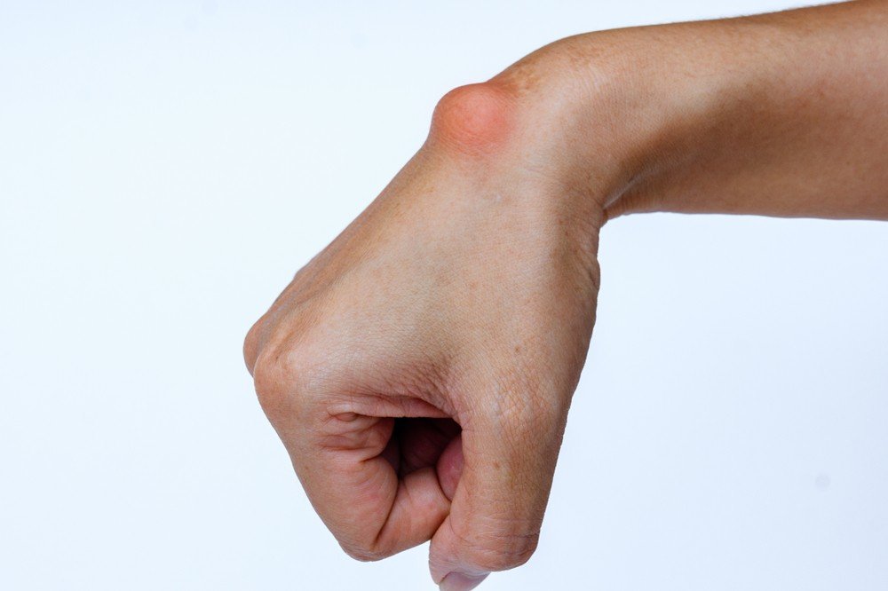 Ganglion Cyst Removal Treatment At Excellence Medical 01 2325528